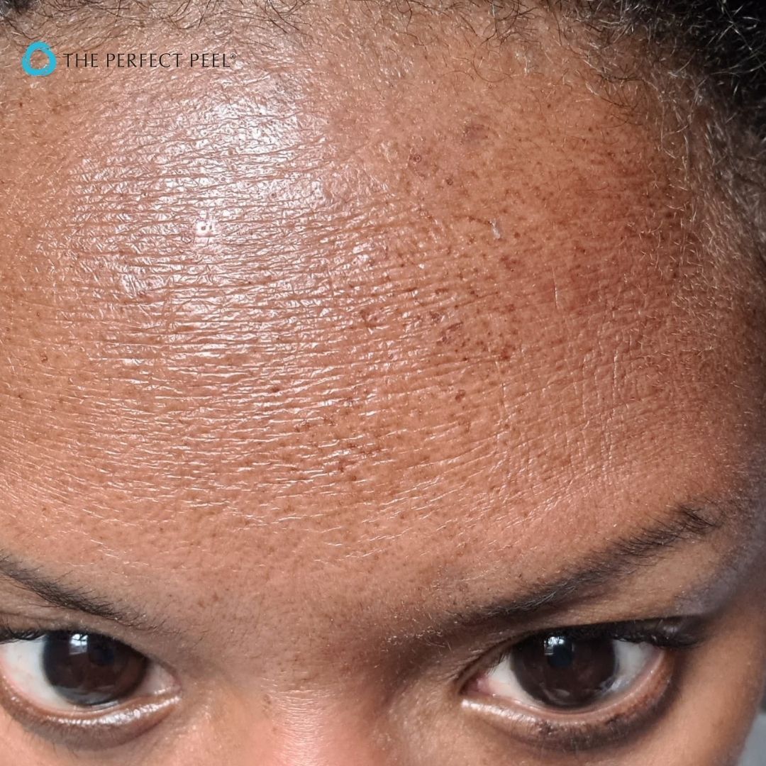 The Perfect Peel Process - Prfkt® Pro