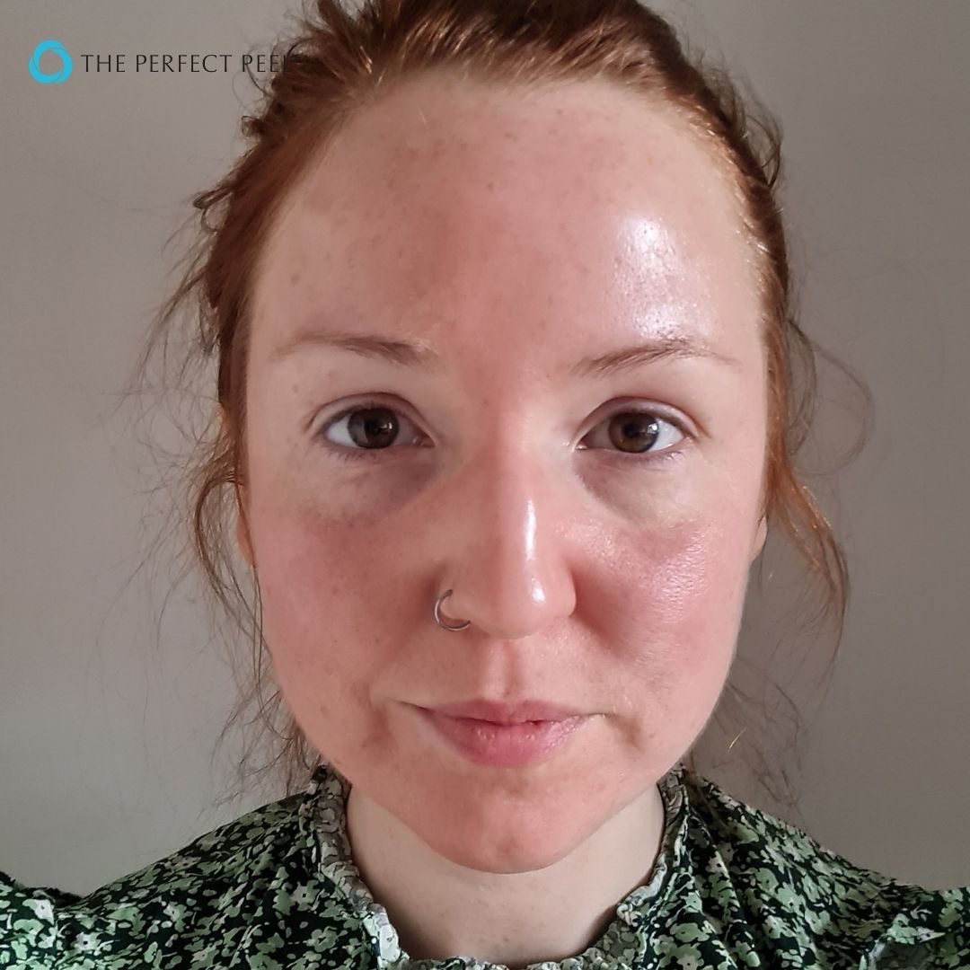 The Perfect Peel Process - Prfkt® Pro