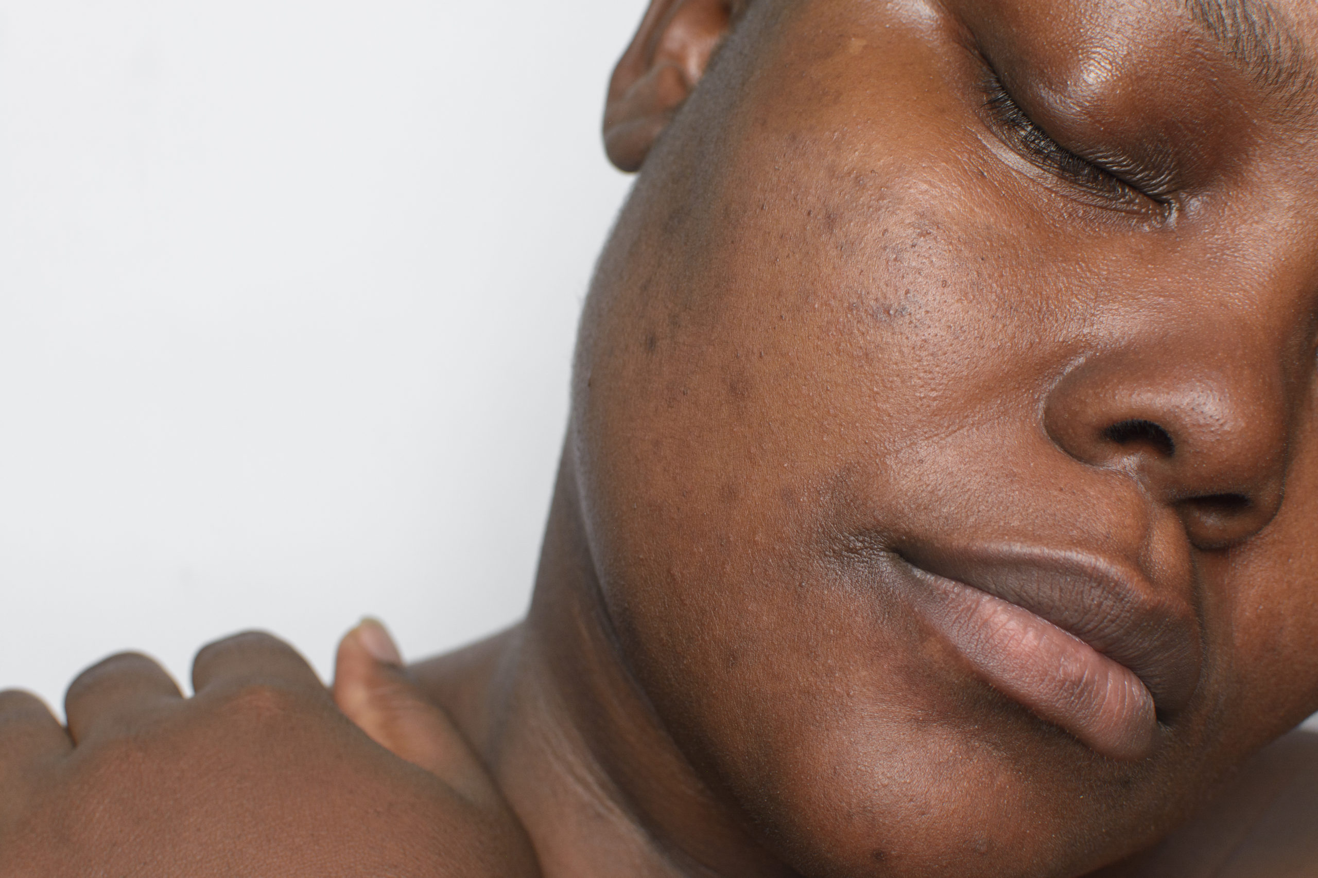 Post Inflammatory Hyperpigmentation | Acne Treatment | Prfkt® Pro
