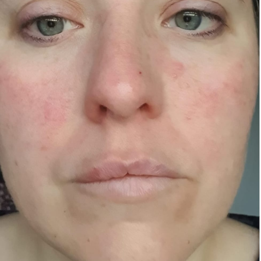 Rosacea | Red Skin Treatment | Prfkt® Pro