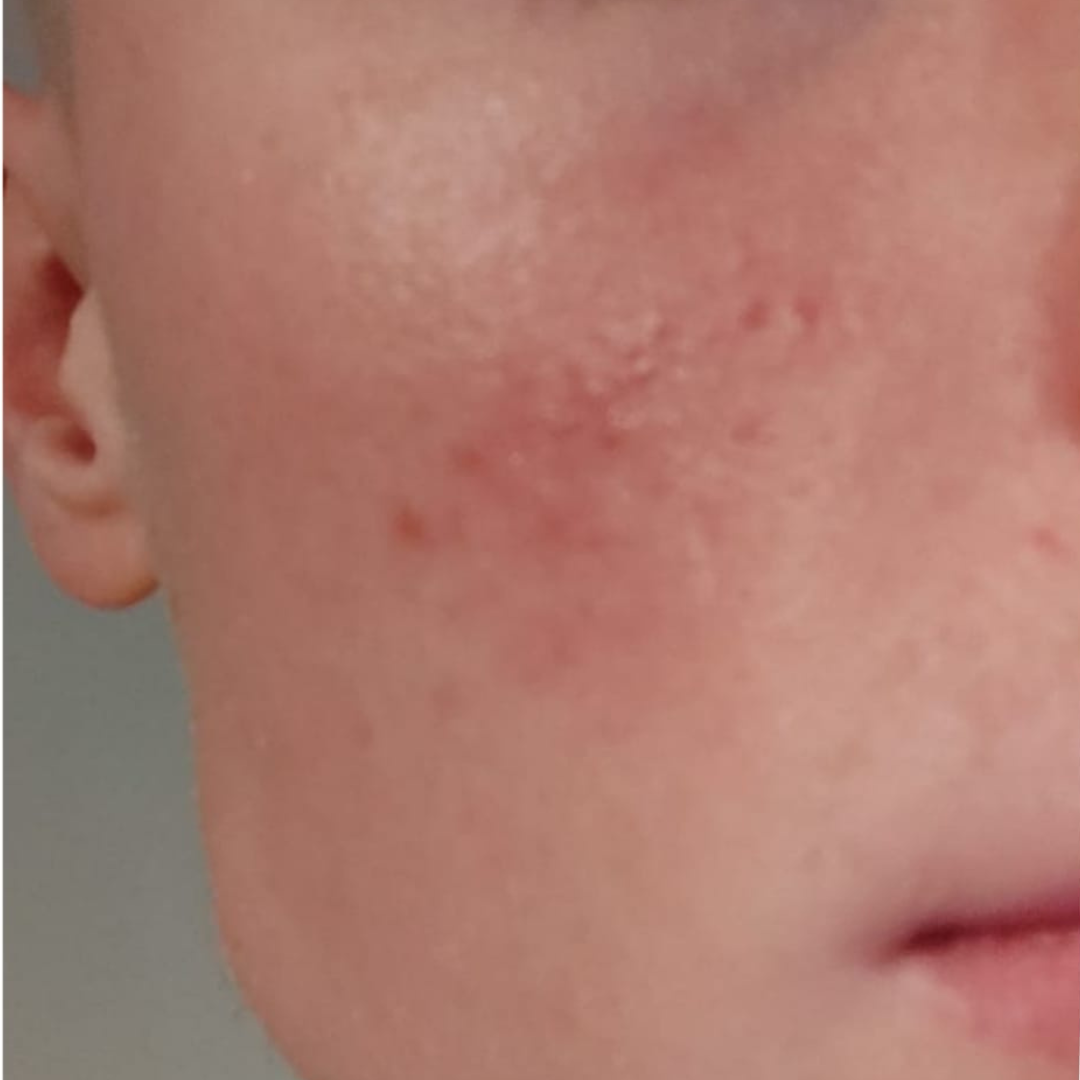 Rosacea | Red Skin Treatment | Prfkt® Pro